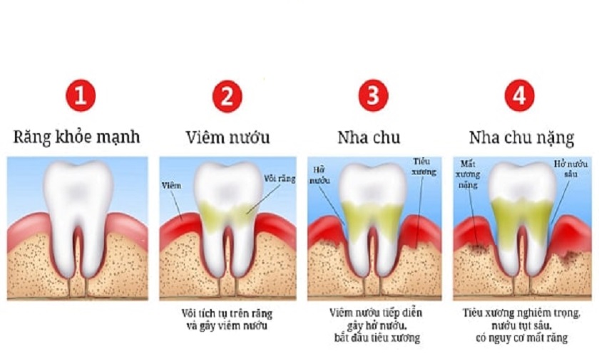 Thế nào là viêm nha chu bệnh học? Cách điều trị bệnh nha chu hiệu quả